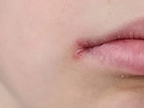Diy Lip Balm for Cracked Lip Corners - That Helps to Soothe Diy Lip Balm for Cracked Lip Corners - That Helps to Soothe