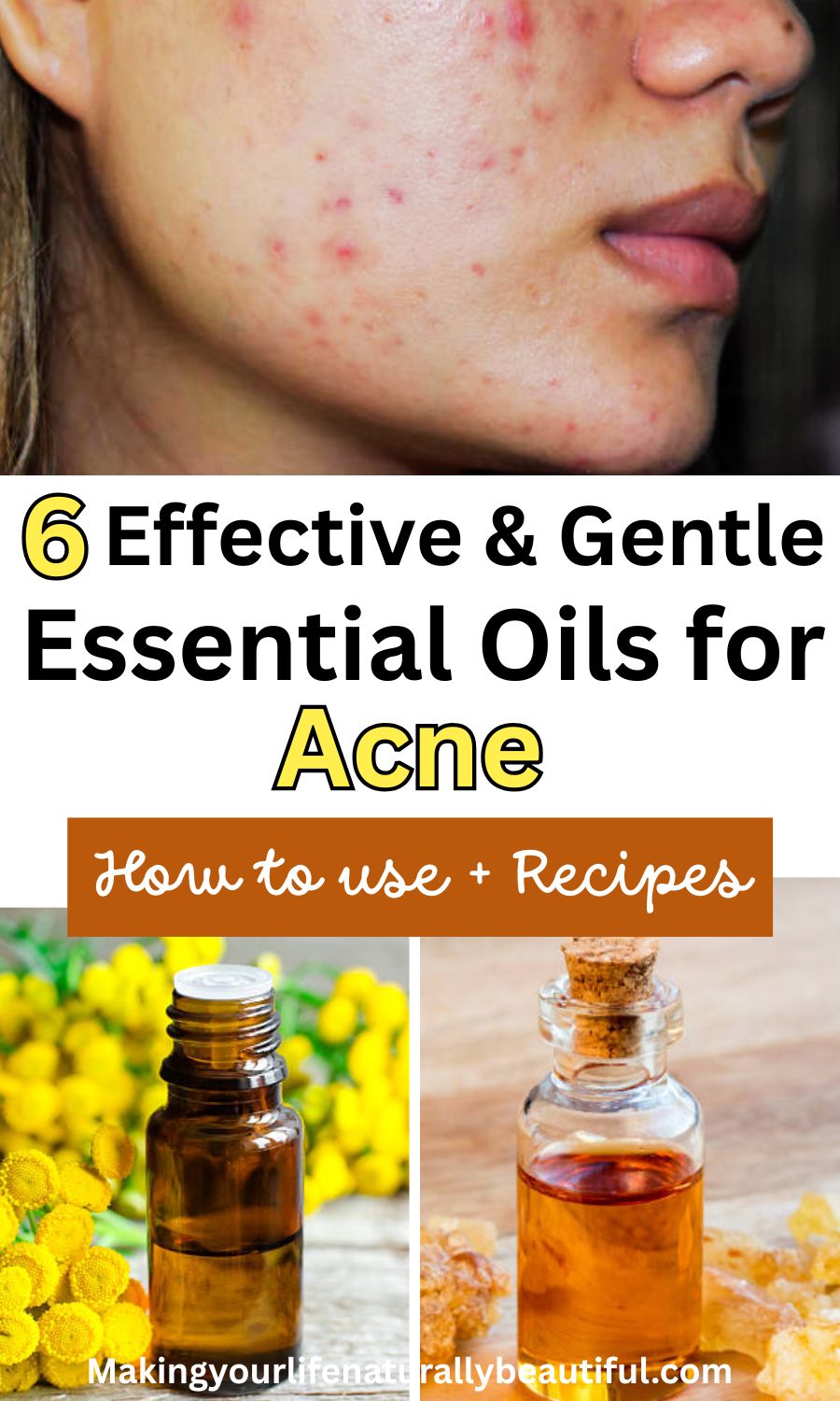 6 Essential Oils for Acne : How to Use + Recipes That Won’t Clog Pores